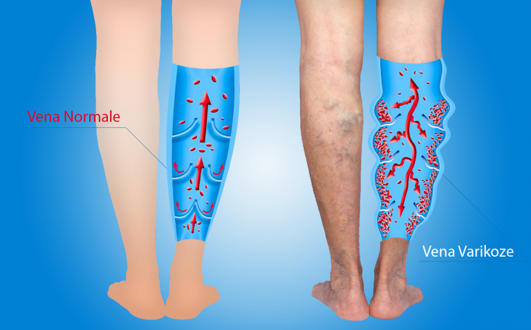 Variçet(Venat Varikoze), diagnostikimi dhe trajtimi i tyre - Spitali ...